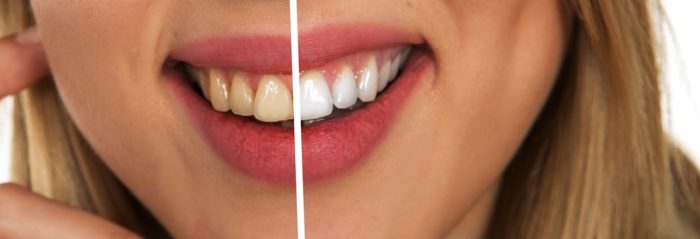 Get Your Teeth Whitened at the Dentist - Regency Dental - Omaha, NE