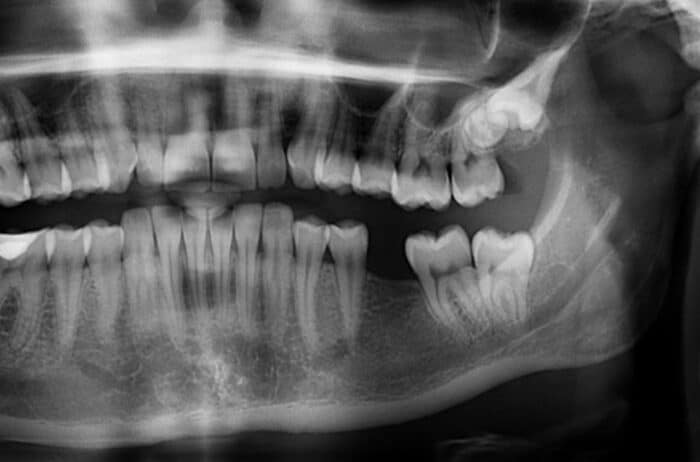Tooth Loss Replacement Options - Regency Dental - Omaha, NE